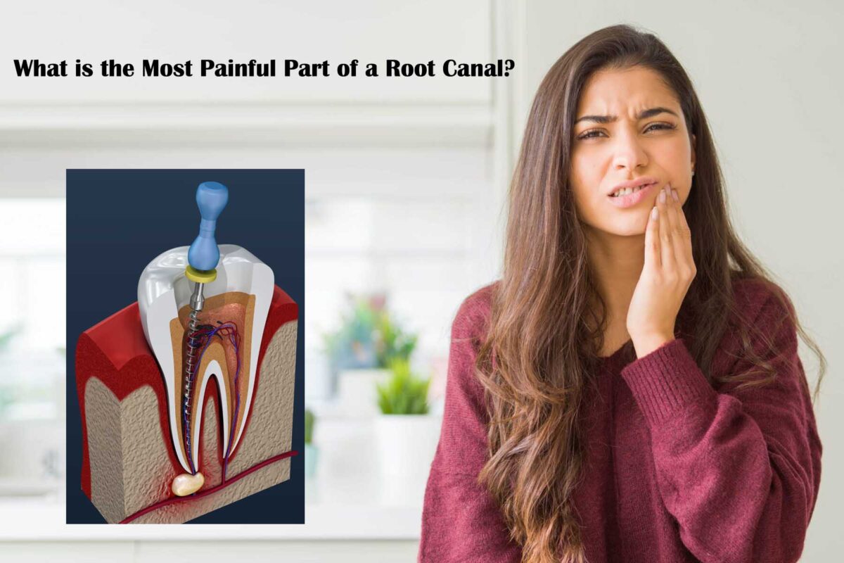 What is the Most Painful Part of a Root Canal? - Humberview Dentistry