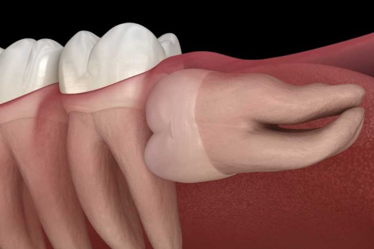How to Reduce Swelling After Wisdom Tooth Removal